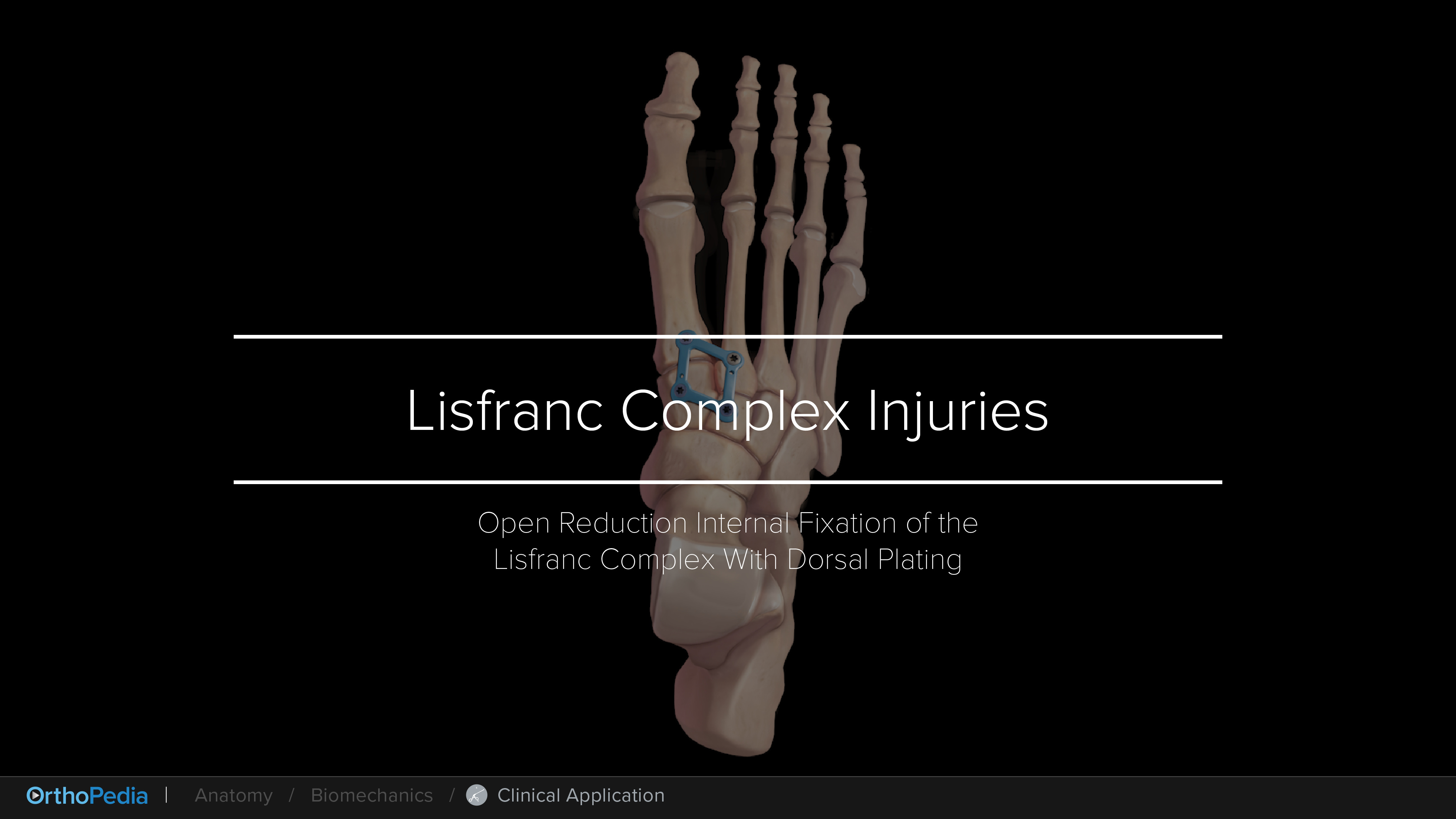 Lisfranc Complex Injuries Open Reduction Internal Fixation Of The Lisfranc Complex Injuries Open Reduction Internal Fixation Of The