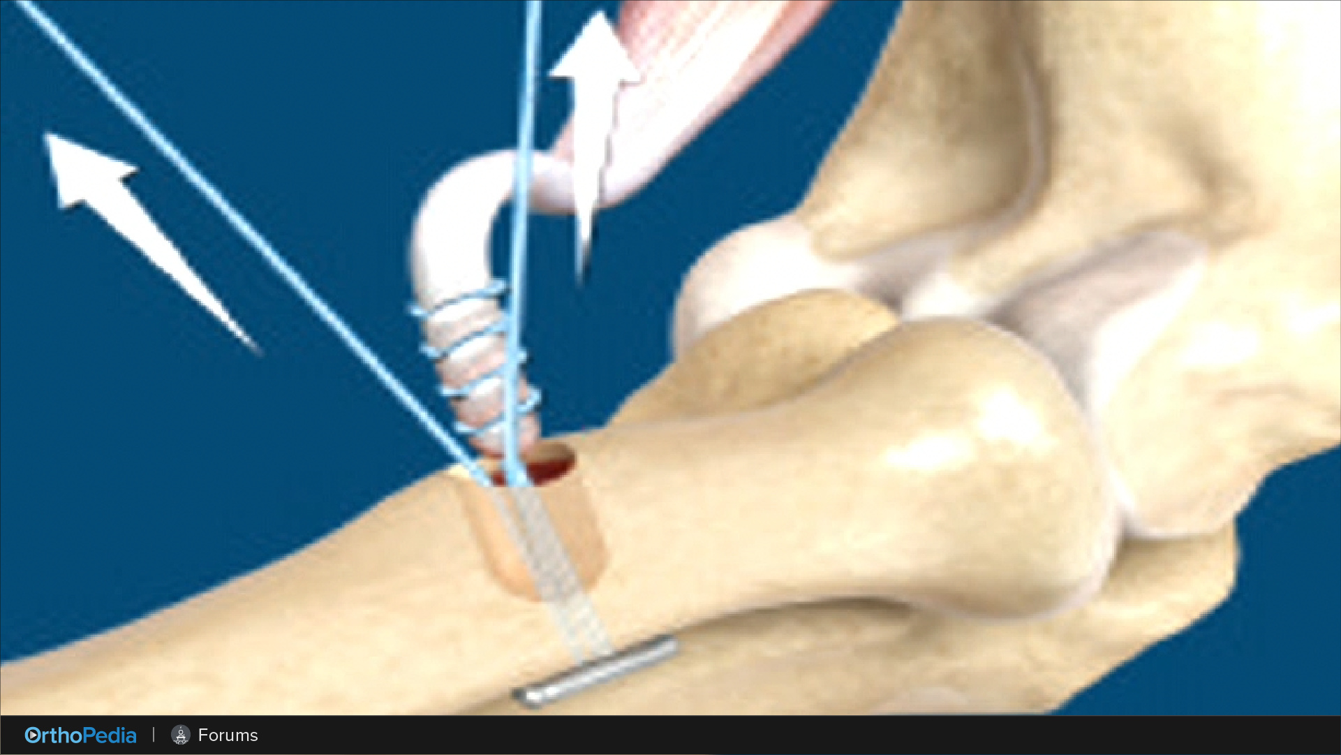 NanoScope™ Visualization System, Trauma, and Minimally Invasive Hand ...