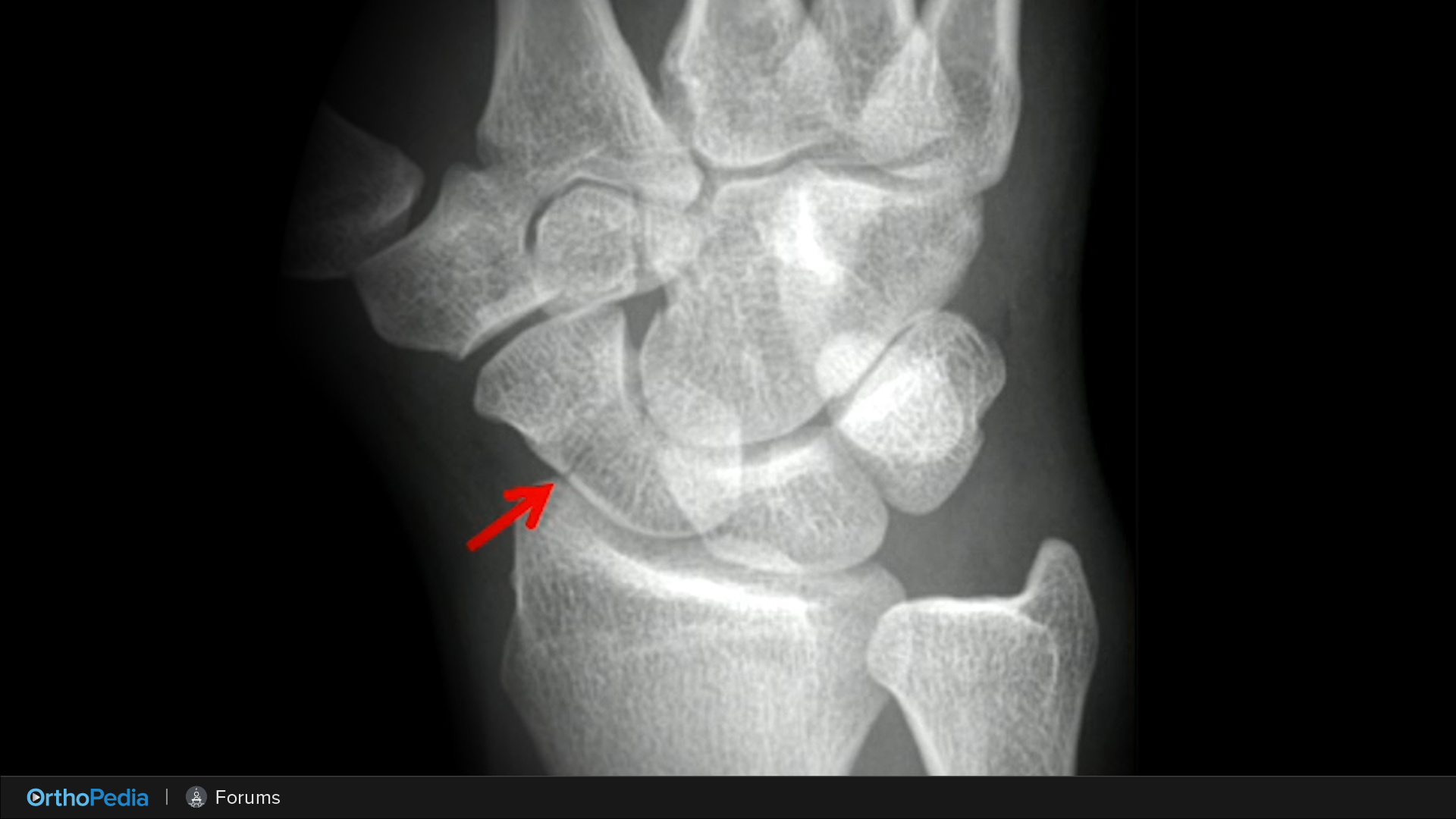 NanoScope™ Operative Arthroscopy System and Minimally Invasive Hand ...