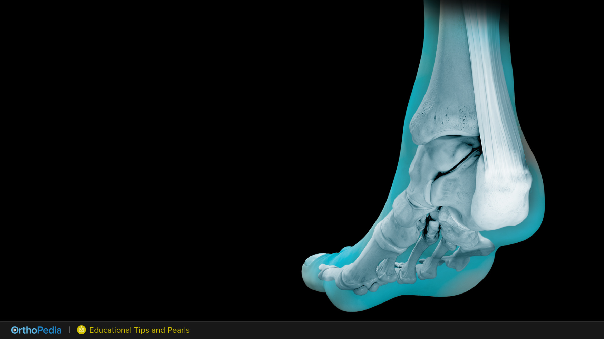 Achilles Tendonitis X Ray