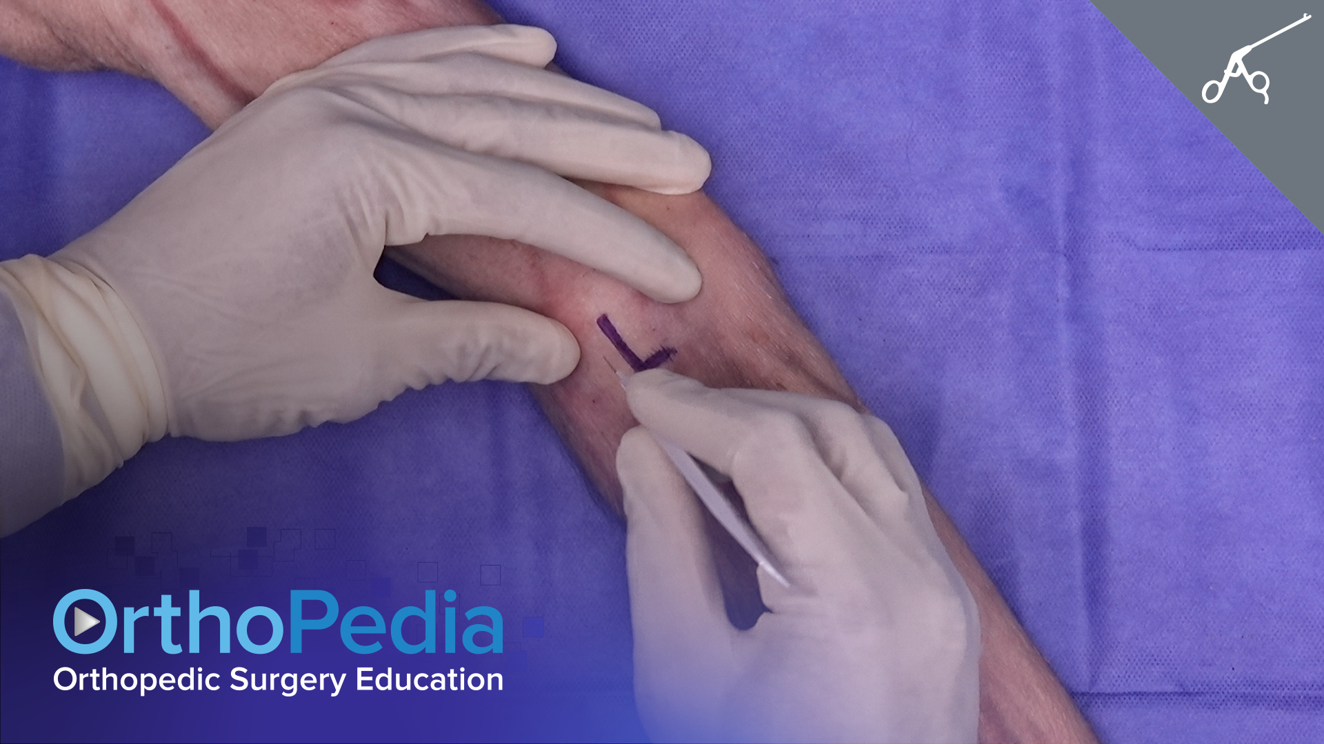 Distal Biceps Tendon Injuries: Suture Anchor Repair Using the FiberTak ...